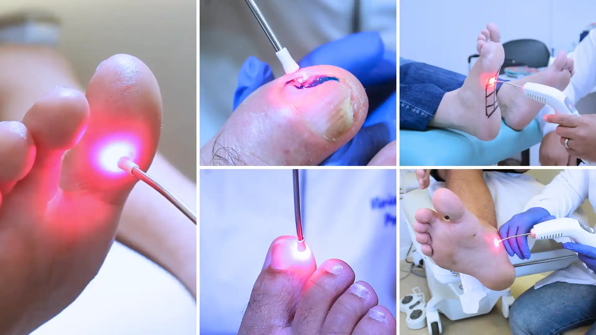 5 formas de usar o Laser na Podologia